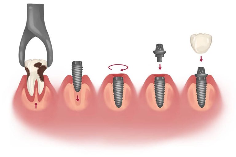IMMEDIATE IMPLANTS – IMMEDIATE FIX! | Dentist in Tucker, GA